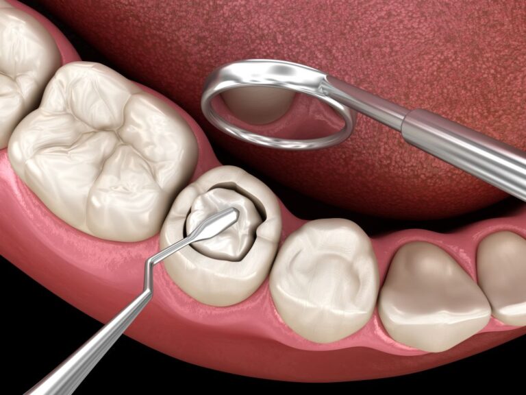 Bonded Fillings near me in highlands, Edmonton, AB